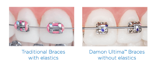 What Are Damon Braces | Orthobar
