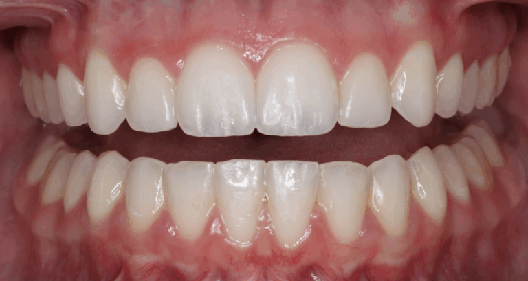 Smile Makeover Without Veneers - The Orthobar Natural Look